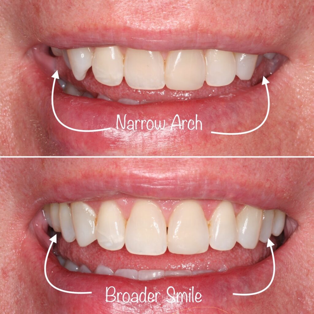 Invisalign Before and After (Schaumburg Dentistry)