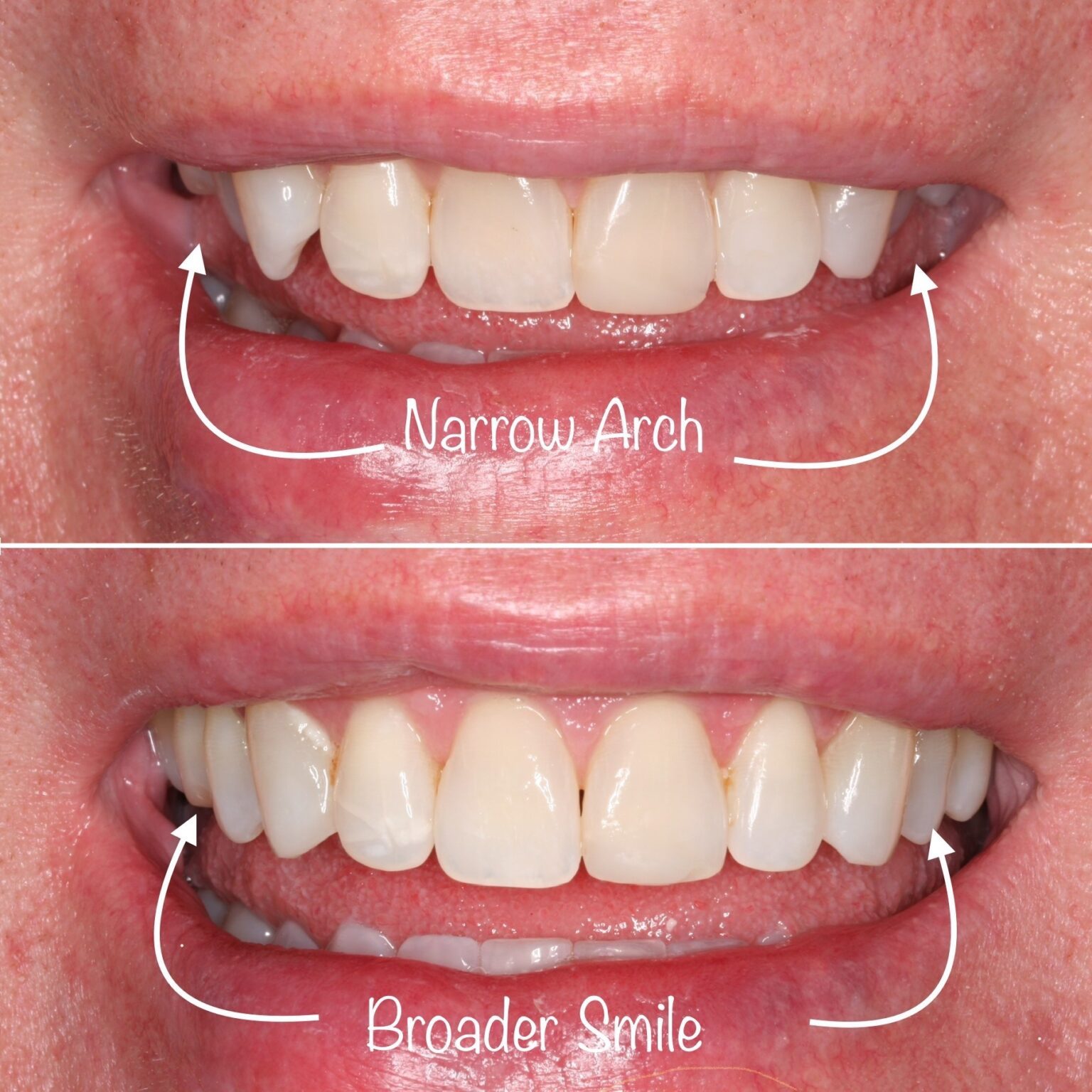 Invisalign Before and After (Schaumburg Dentistry)