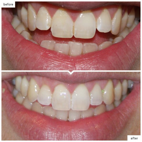 Invisalign Before and After: Real Transformations